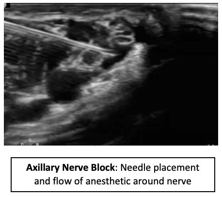 Ultrasound-Guided Regional Anesthesia for Improved Nerve Block Success ...