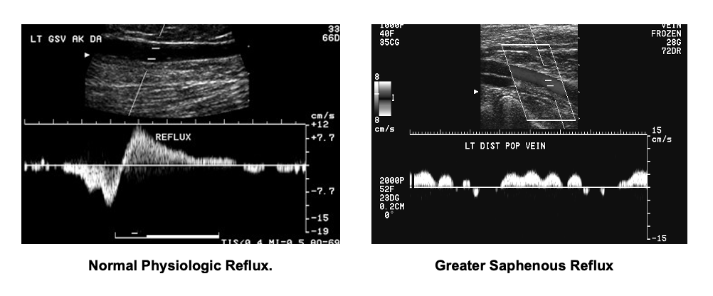 Venous Duplex Ultrasound is the Primary Imaging Modality for Reflux ...