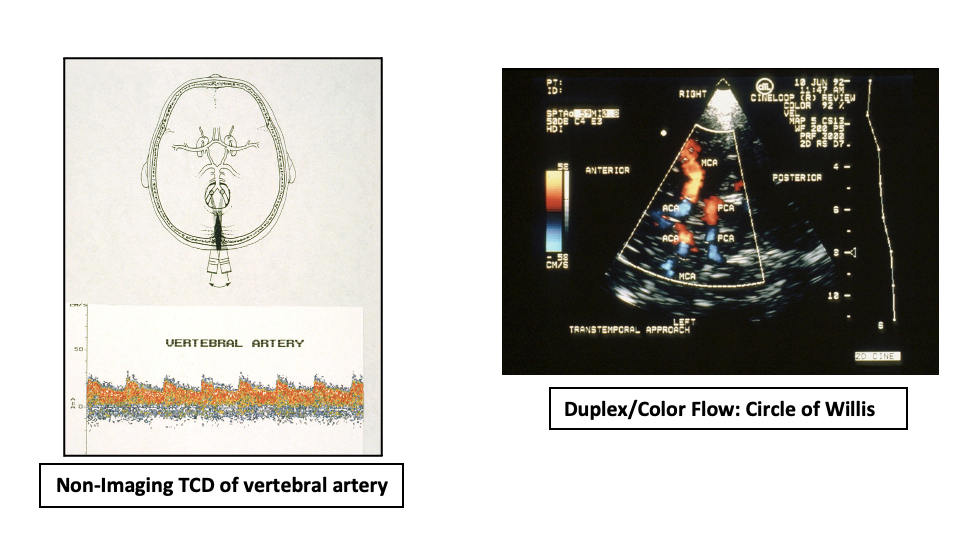 Transcranial Doppler Ultrasound: A Valuable Diagnostic Tool - Gulfcoast ...