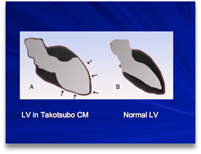 Echocardiography Evaluation of Takotsubo Cardiomyopathy - Gulfcoast ...