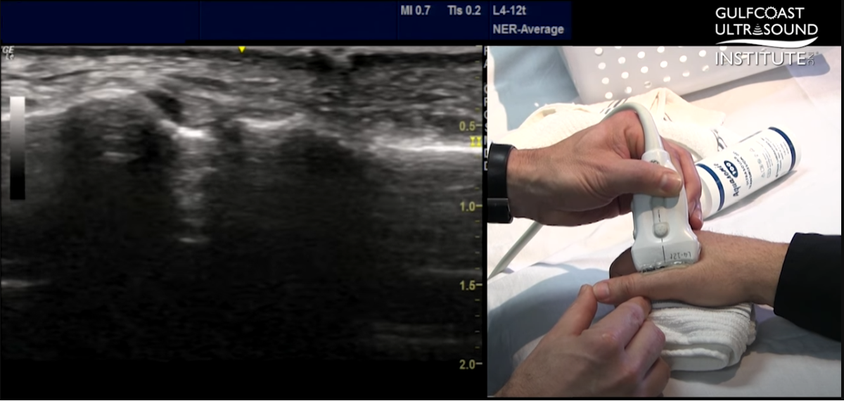 Ultrasound Evaluation of Gamekeeper's Thumb aka Skier's Thumb - Jon ...